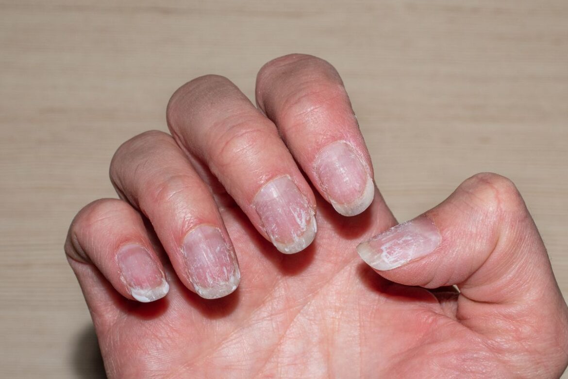Damaged Nails After Removal? Why It Happens and 7 Tips to Repair Them ...