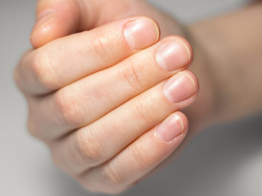 Damaged Nails After Removal? Why It Happens and 7 Tips to Repair Them ...